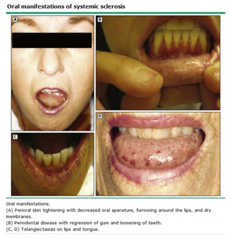 Scleroderma And Crest Syndrome Flashcards Quizlet
