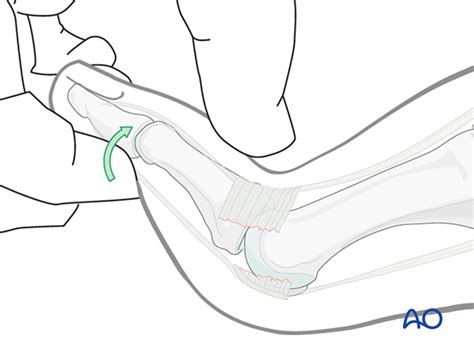 Crif K Wire Fixation For Mtp Joint Dislocation