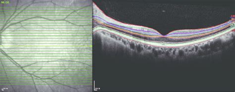Normal Retinal Segmentation In Sd Oct Nine Retinal Layers Were Download Scientific Diagram