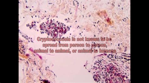 Cryptococcus Fungi The Cause Of Cryptococcosis YouTube