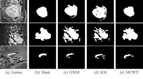 comparative analysis of unsupervised algorithms for breast mri lesion