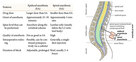 What Is An Epidural Anesthesia