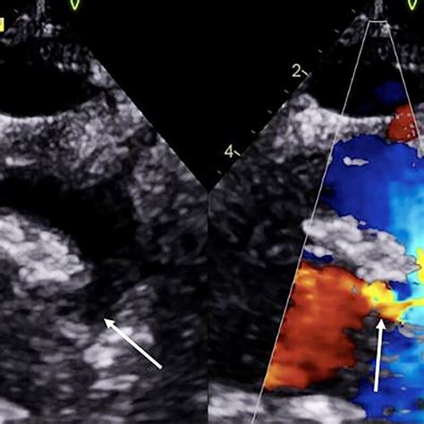 Patent Ductus Arteriosus Pda Dual Display Gray Scale Left And