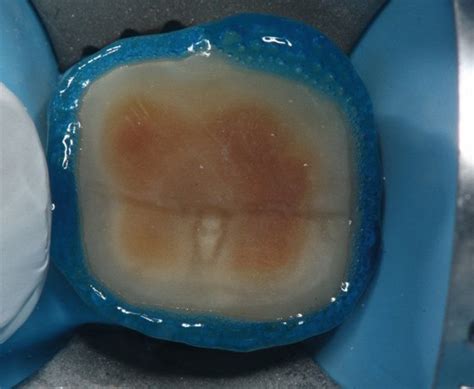 Clinical Case Selective Etch Adhesive Bonding Of A Metal Onlay Solventum