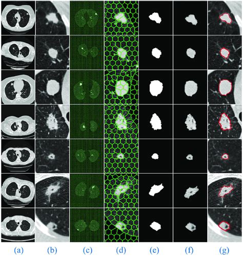 The Segmentation Results Of Our Method For Solitary Pulmonary Nodules Download Scientific