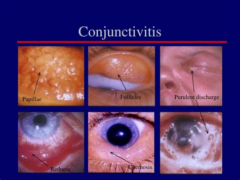 Differential Diagnosis Conjunctivitis At William Trusty Blog