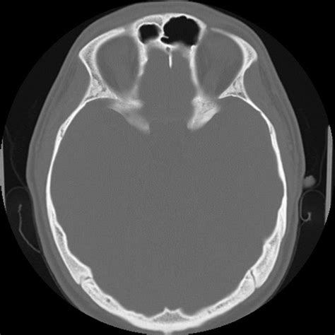 Normal Temporal Bone CT With Annotated Images Radiopaedia Axial Non Contrast NC