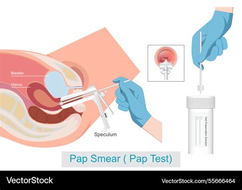 Pap Smear Cervical Cancer Screening Royalty Free Vector