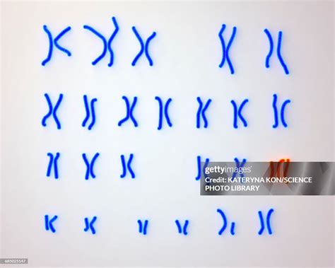 Edwards Syndrome Chromosomes