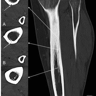 PDF The Anatomy Of The Tibial Nutrient Artery CanalAn Investigation Of Patients Using