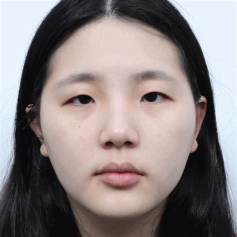 The Truth About Ptosis Correction In Korea Surgical Challenges With