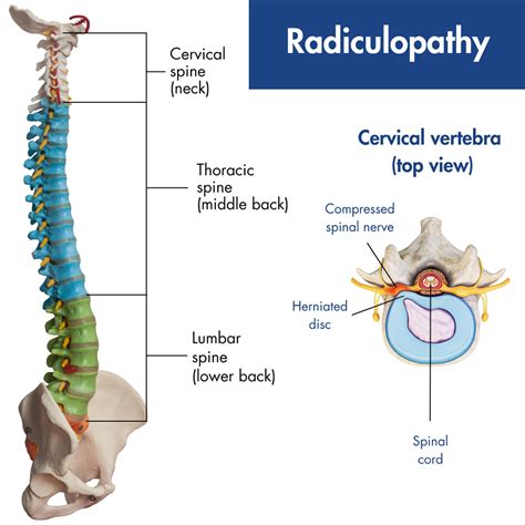 Lumbar Spine Nerve Root Irritation