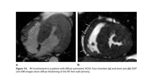 Cardiomyopathy Cardiac Mri Carduiac Ct Imaging Pptx Heart And Cardiovascular Diseases