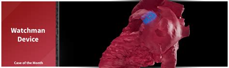 Case Of The Month Watchman Device 3d And Quantitative Imaging Laboratory
