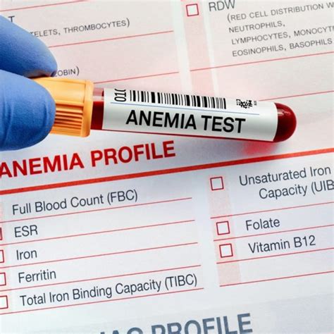 Anemia Haemolytic Type Motherwit Lab Jaipur
