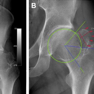Magnetic Resonance Arthrogram Showing Anterolateral Labral Tear And Download Scientific Diagram