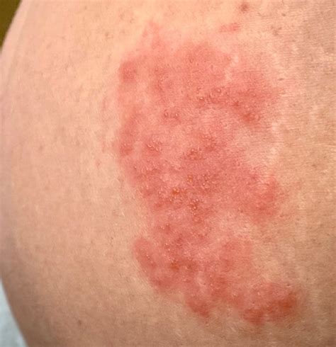 Shingles What Is It And Am I At Risk