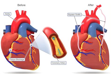 Heart Bypass Surgery Dr Rahul Bhushan