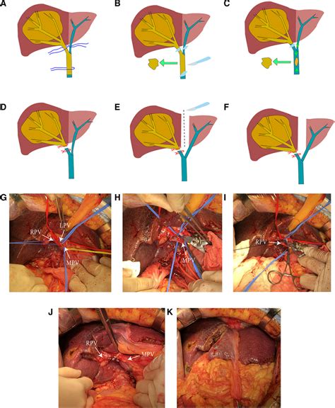 A Anatomical Separation Showing The Lpv Rpv And Mpv B Blocking Download Scientific