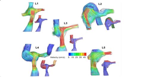 4d Flow Dynamics Computational Flow Dynamic Demonstrating Velocities