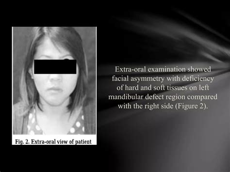 Mandibular Defects Maxillofacial Prosthesis Pptx