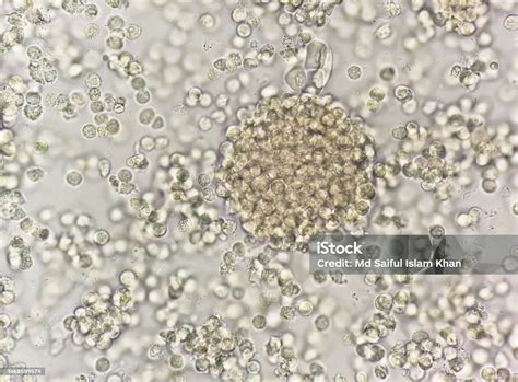 Piuria Causas Síntomas Manejo Y Tratamiento Guía De Salud Vidaliax