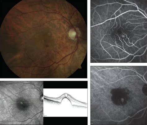 How Baseline Assessment Of Amd Lesion Type Influences Clinical