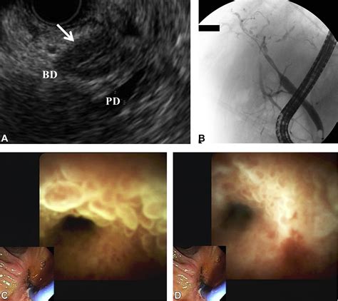 Direct Visualization Of Igg4 Related Cholangiopathy Gastrointestinal