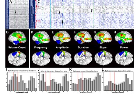 Spatial Relationship Between Tumor And Electrophysiological Data