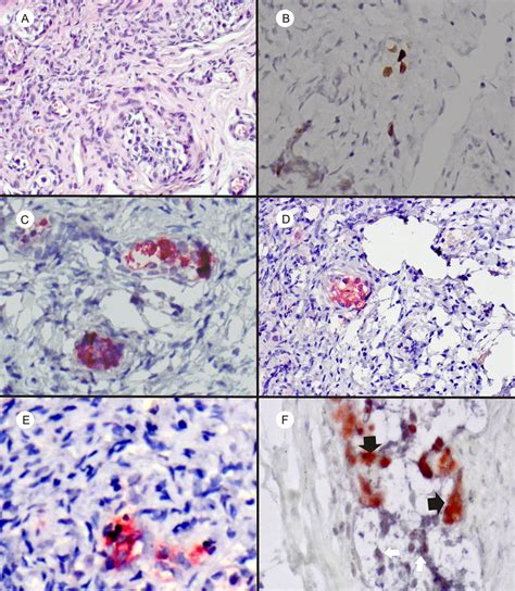 Gonadal Malignancy In 13 Consecutive Collected Patients With Disorders Of Sex Development Dsd
