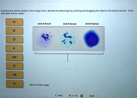 Examine The Blood Sample In The Image Then Identify The Blood Type By