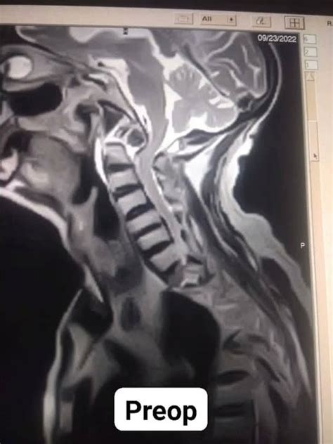 C1 C2 Fusion And Fixation Youtube