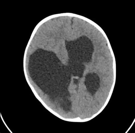 Endoscopic Fenestration Of Intraventricular Arachnoid Cyst Encyclopedia Of Neuroendoscopic
