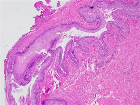 Epidermal Inclusion Cyst Labia