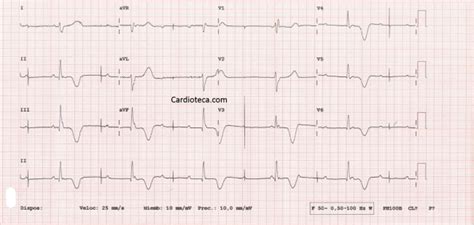 Curso Ecg Flutter Auricular Común