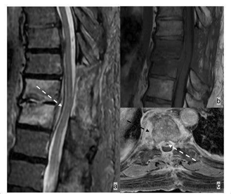 Ab Patient Had Prior Tt Decompression Laminectomy Stir Sagittal