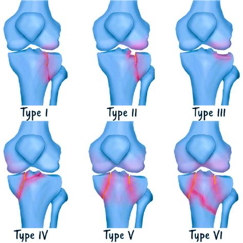Schatzker Classification Of Proximal Tibia Fracture 1974 Download Scientific Diagram