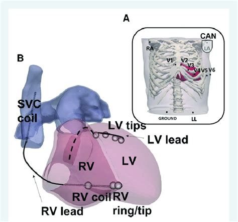 A ECG Electrodes B Modelling Of A Generic Implanted Device ECG Download Scientific