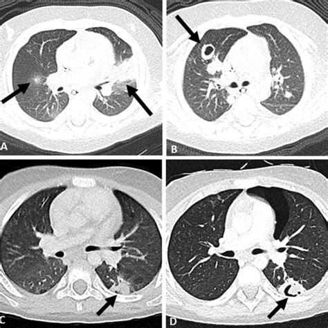 Imaging Findings In Invasive Pulmonary Aspergillosis A B—6 Month Old