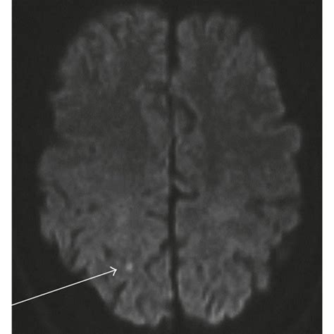 MRI Brain Demonstrating A Focus Of Restricted Diffusion In The Right Download Scientific