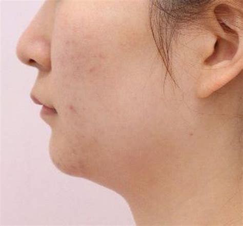 파워v얼굴지방흡입 이중턱근육묶기 보톡스 후기 닥터정 리반의원