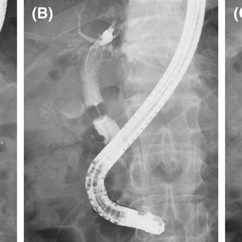 The Findings Of The Second Endoscopic Cholangiography A No Stones In Download Scientific