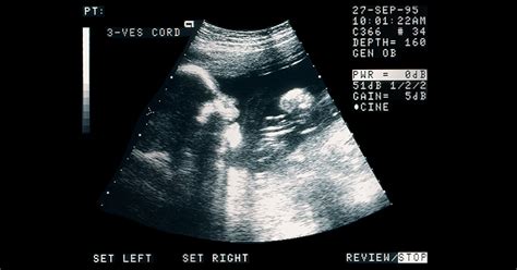 Committee Advances Bill Adding Pregnancy Ultrasound Video To Indiana