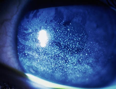 Ocular Symptoms Gp Eyes Ocular Symptoms Gp Eyes