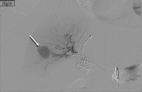 Percutaneous Thrombin Injection For Treatment Of A Hepatic Arterial