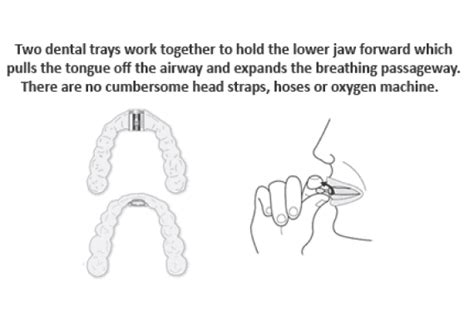 What Is Oral Appliance Therapy