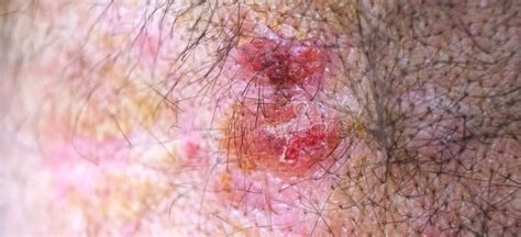 Skin Lesion Symptom In Shingles Or Herpes Zoster In Person Viral
