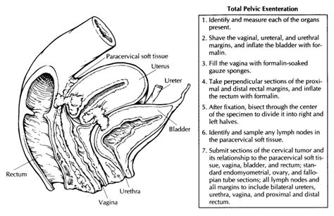 Radical Hysterectomy For Cervical Cancer