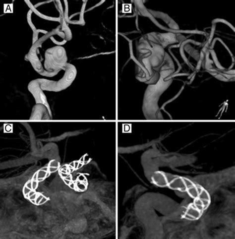 Right And Left Ica Paraophthalmic Segment Aneurysms Treated With A Silk