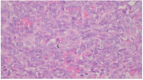 Gastrointestinal Disorders Free Full Text Mesenchymal Tumors Of The Gastrointestinal Tract